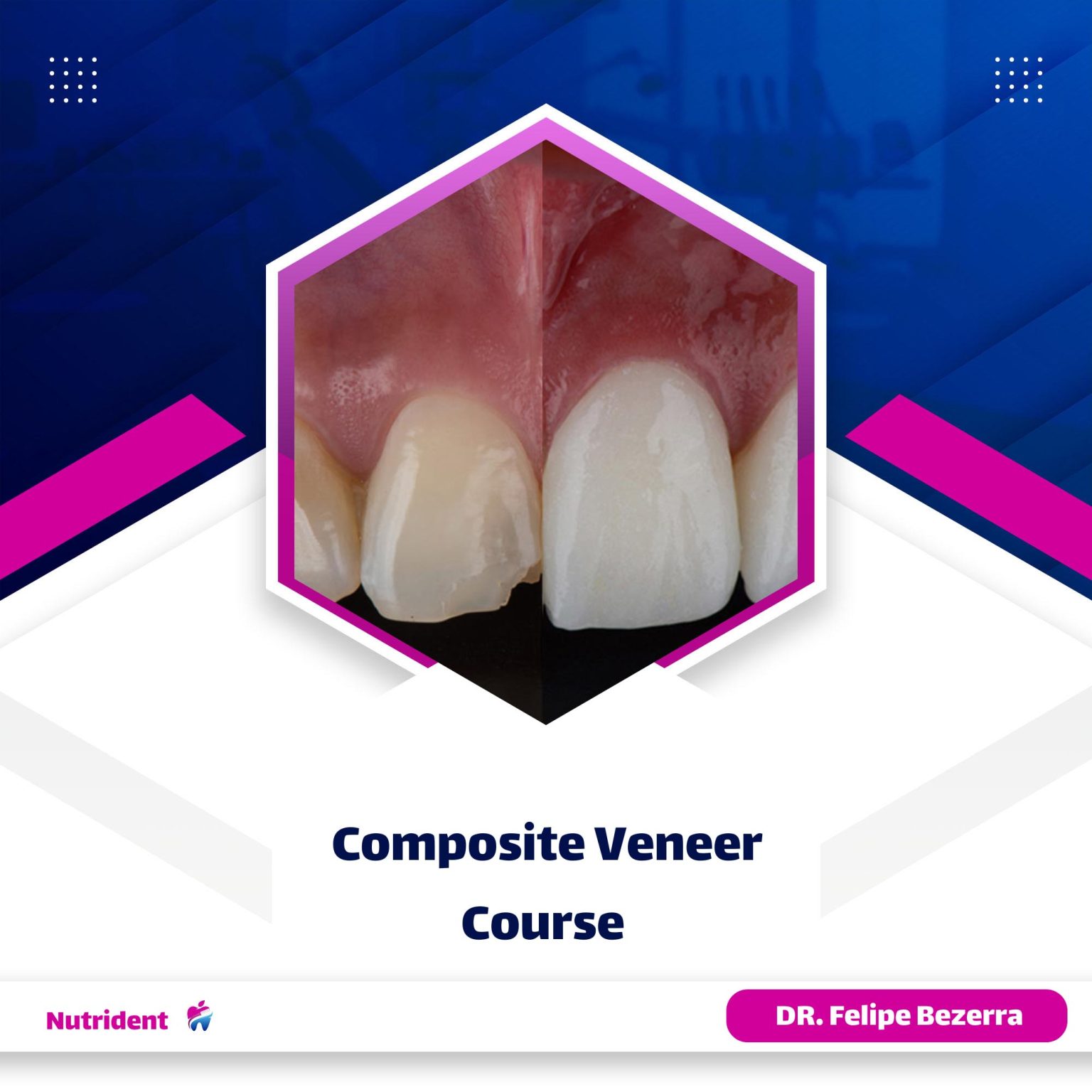 Composite veneer course - Nutrident