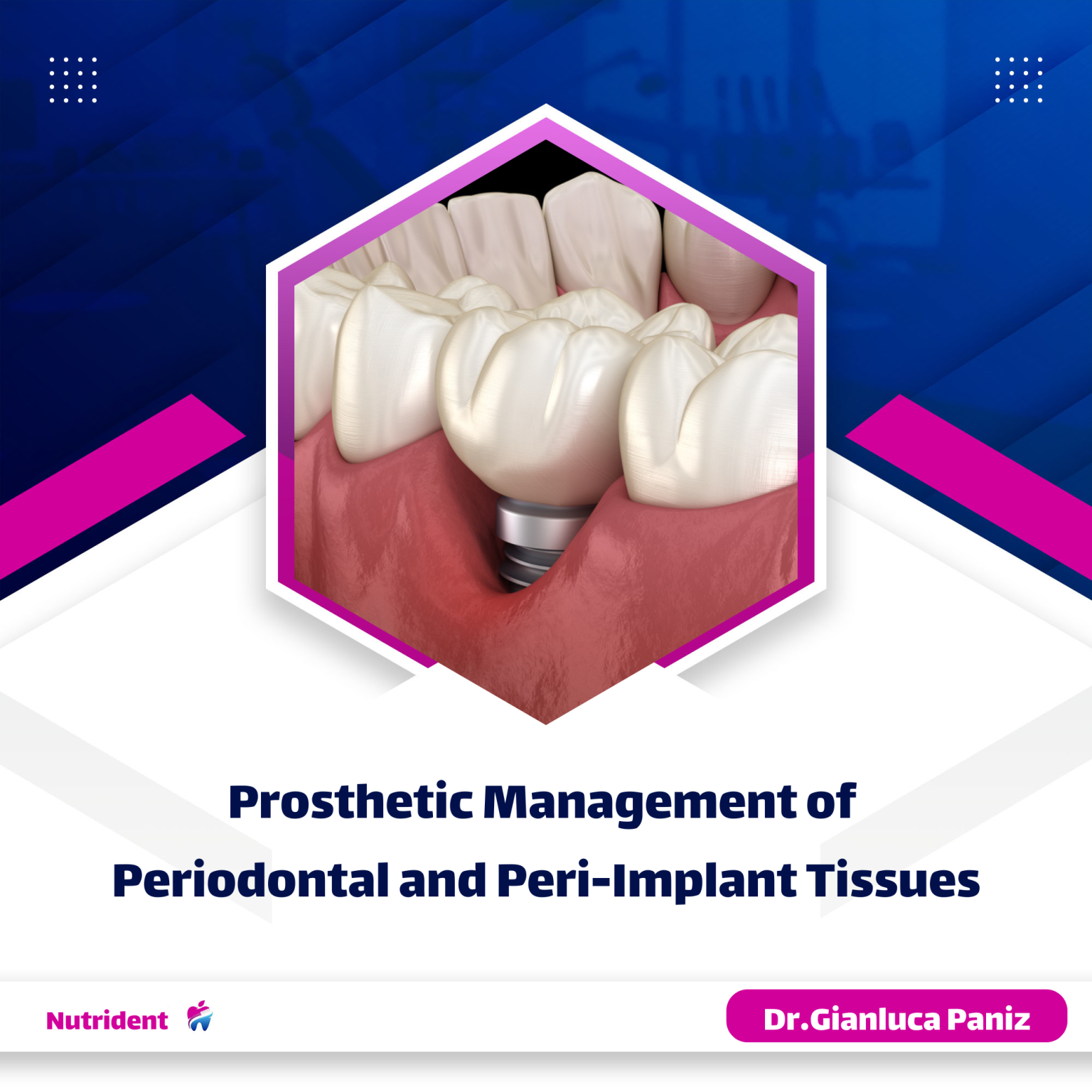 Prosthetic Management Of Periodontal and Peri-implant Tissue - Nutrident