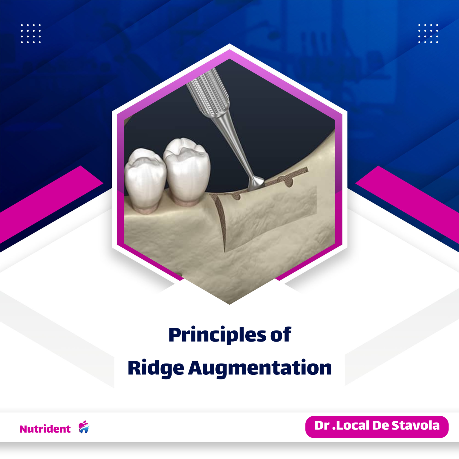 Principles Of Ridge Augmentation - Nutrident